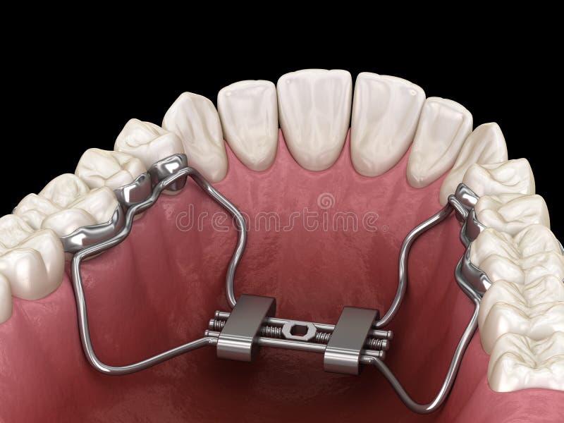 Rapid Palatal Expansion. Medically Accurate Tooth 3D Illustration Stock ...