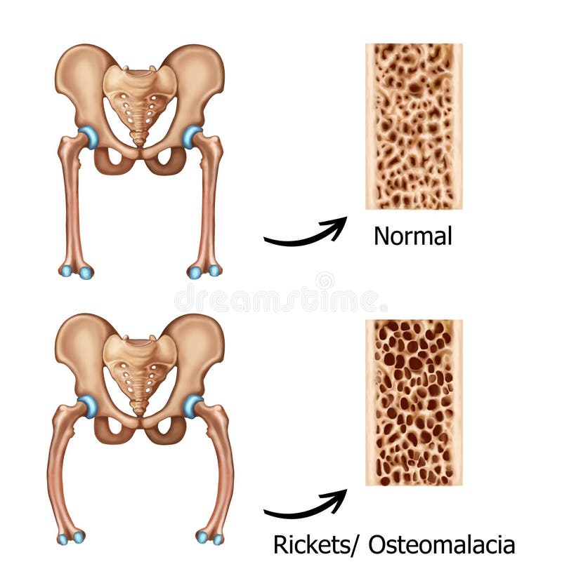 Raquitismo-osteomalacia ilustração stock. Ilustração de quadril - 75699746