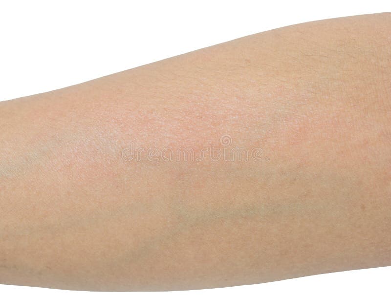 Rash, in the Skin, and Itching. Stock Photo - Image of medicine, body ...
