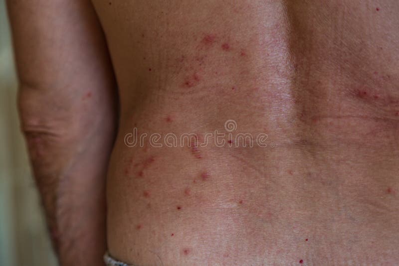 Rash on back skin stock photo. Image of medical, medicine - 91163696