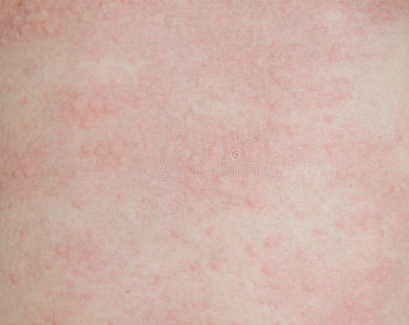 Rash in body Skin problems stock photo. Image of pimple - 125385736