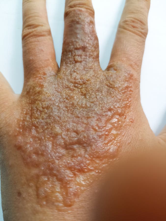 Rash Eczema Dermatitis on Finger Hand. Inflammation of Skin Stock Photo ...