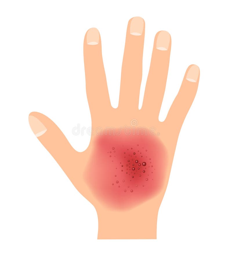 Rash Stock Illustrations – 4,680 Rash Stock Illustrations, Vectors ...