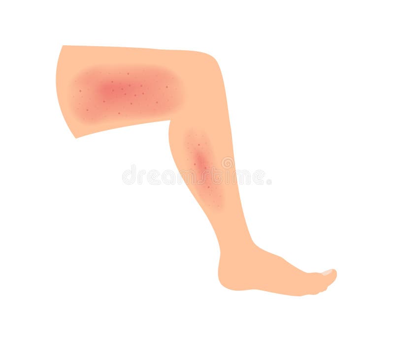 Rash Stock Illustrations – 9,813 Rash Stock Illustrations, Vectors ...