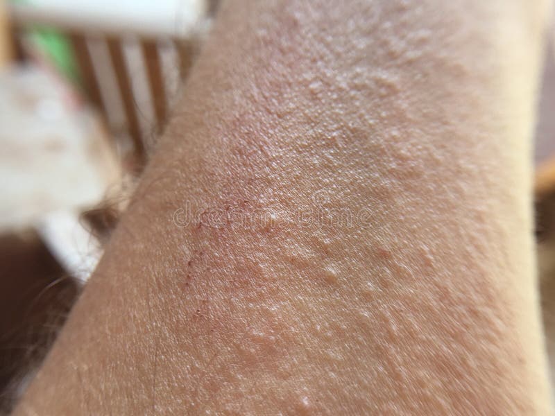 Rash on man hand stock photo. Image of itchy, dermatitis - 145977518