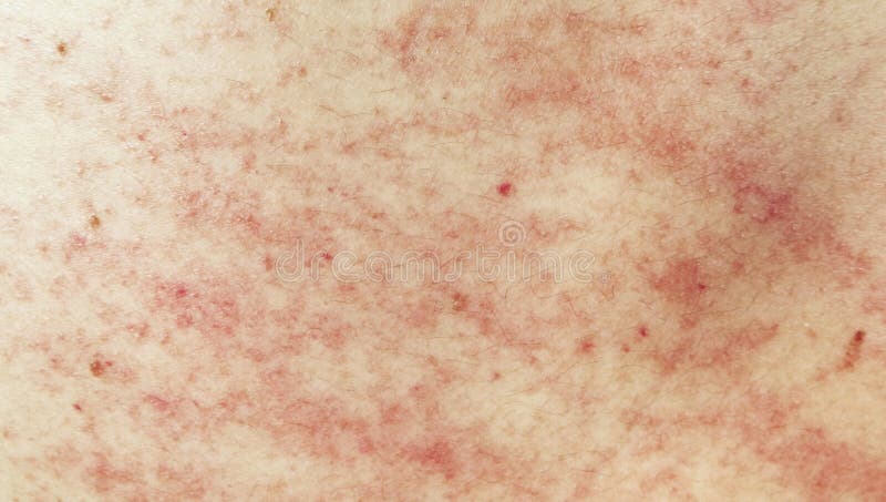Rash on sensitive skin stock photo. Image of female - 103166722
