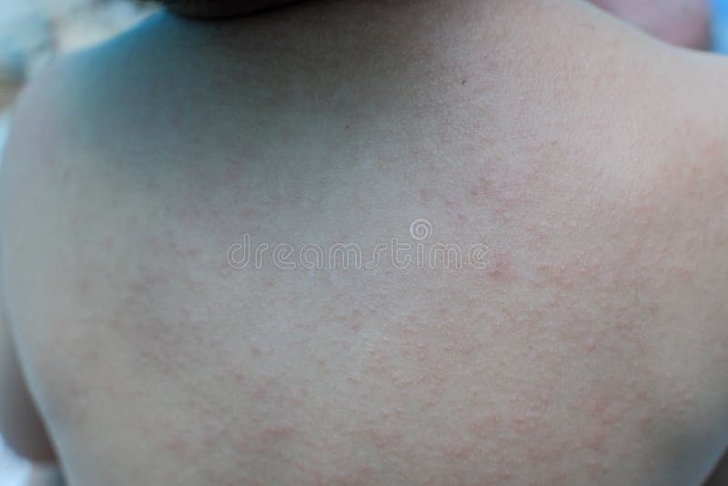 Rash on Sensitive Skin or Skin Problem with Allergy Rash Stock Image ...