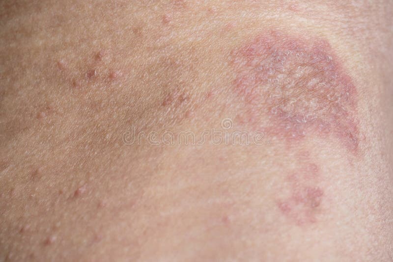 Rash on Sensitive Skin or Skin Problem with Allergy Rash Stock Image ...