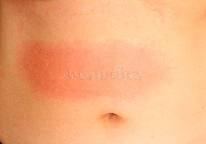 Rash on sensitive skin stock image. Image of allergic - 69180067