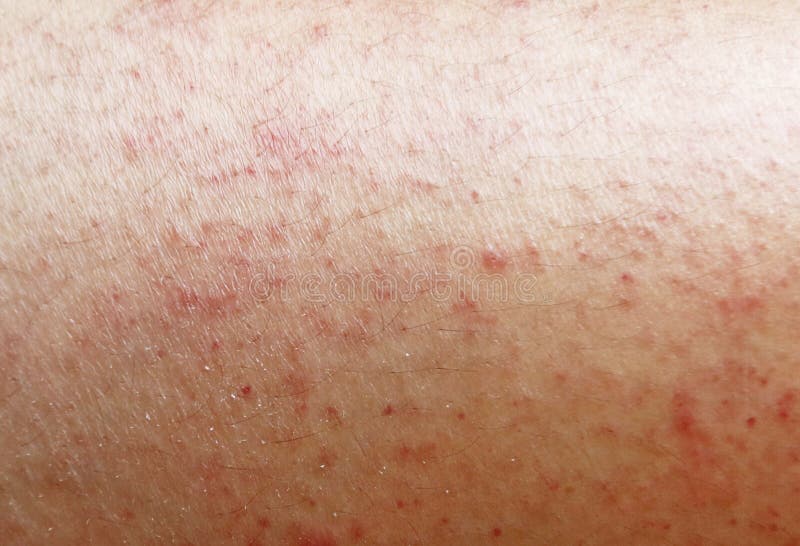 Rash on sensitive skin stock photo. Image of spotty - 103166802