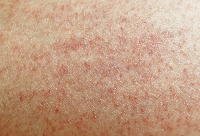 Rash on sensitive skin stock image. Image of freckle - 103166745