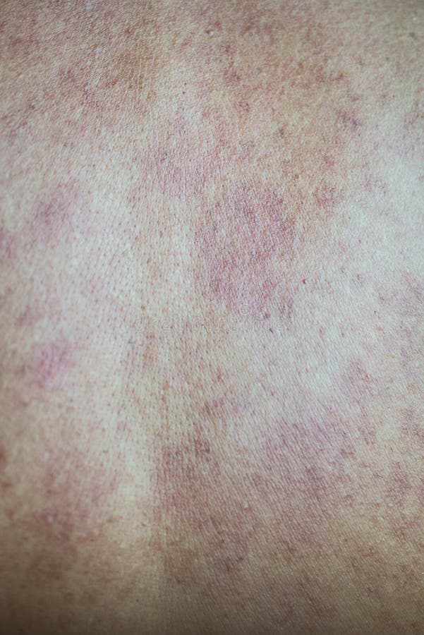 The rash is a skin disease stock photo. Image of ailment - 328599826