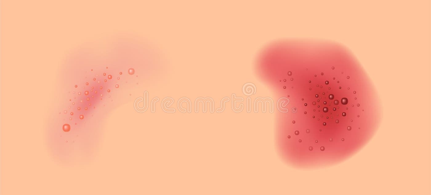 Rash Disease Stock Illustrations – 7,540 Rash Disease Stock ...