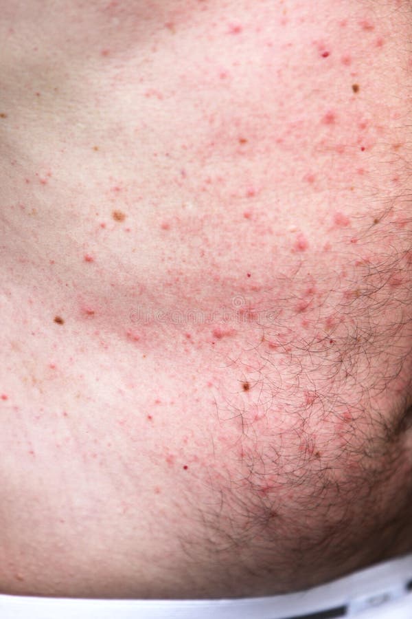 Rash or sun allergy stock image. Image of allergy, acne - 14962597