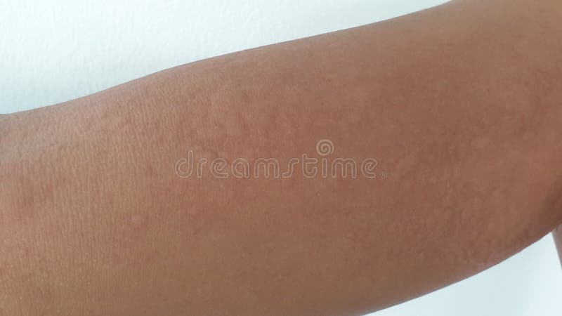Rash Swelling from Allergic on Arm, Rod Allergy Stock Photo - Image of ...