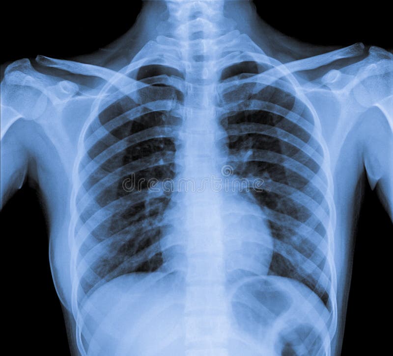 Rayo normal del pecho X foto de archivo. Imagen de pecho - 74660496