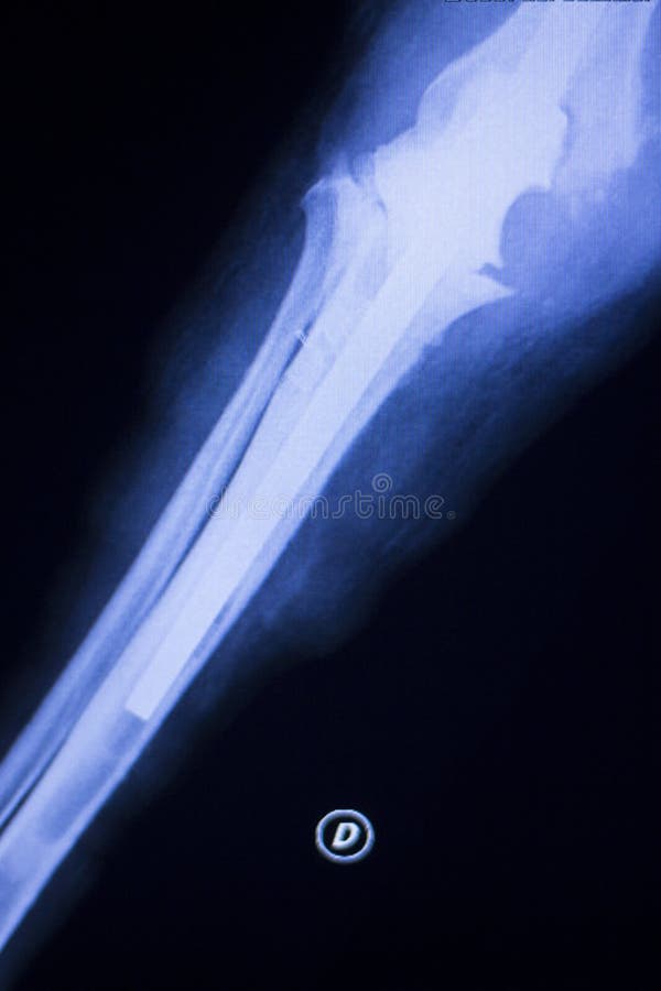Rayon X D'implant D'articulation Du Coude Image stock - Image du ...