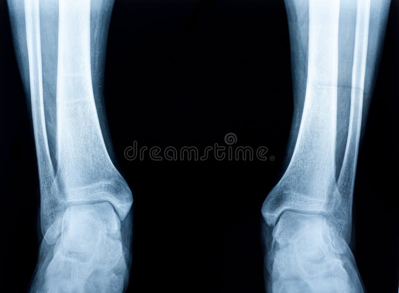 Rayon X D'une Cheville Humaine Photo stock - Image du clinique, commun ...