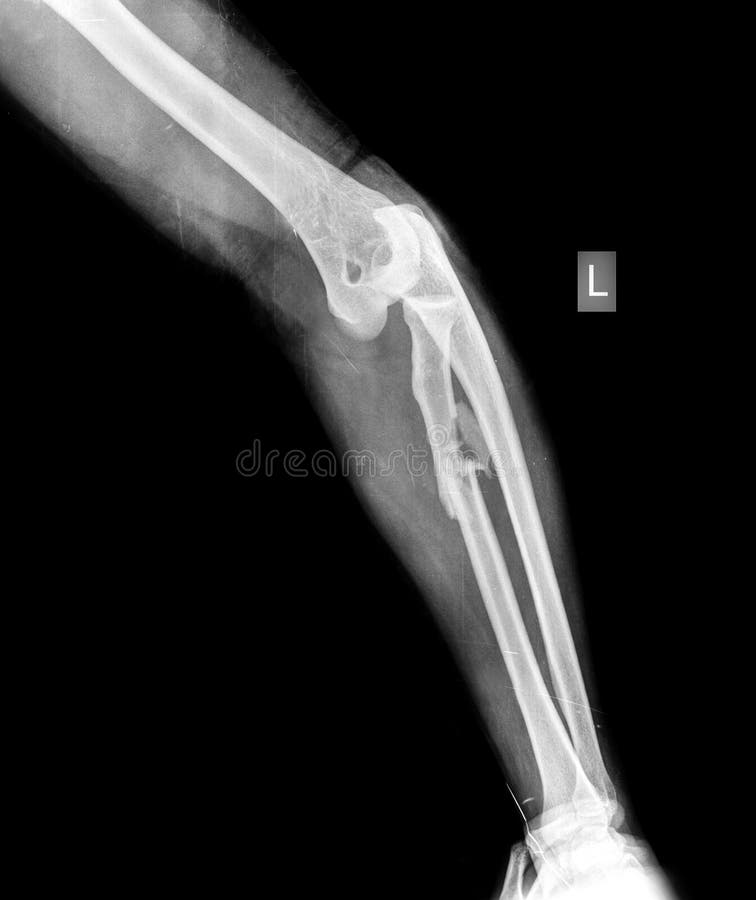 Rayon X D'implant D'articulation Du Coude Image stock - Image du ...