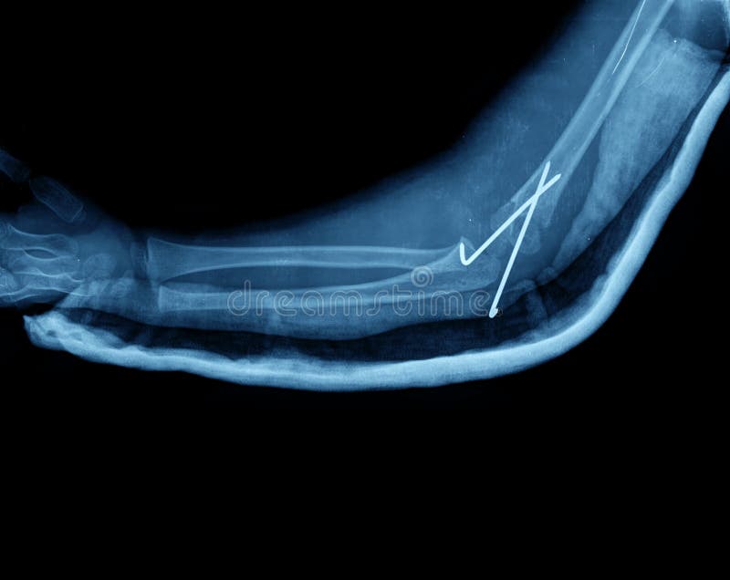Rayon Distal De Fracture (l'os De L'avant-bras) Image stock - Image du ...