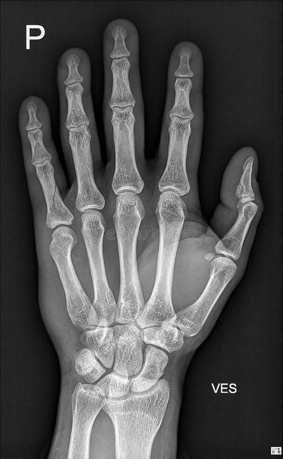 Rayon X de main photo stock. Image du incrément, humain - 71549976