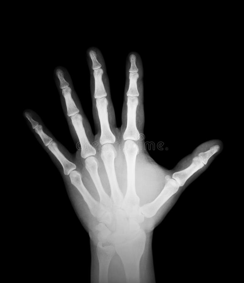 314 Photos de Radiographie De Main Et De Poignet - Photos de stock ...