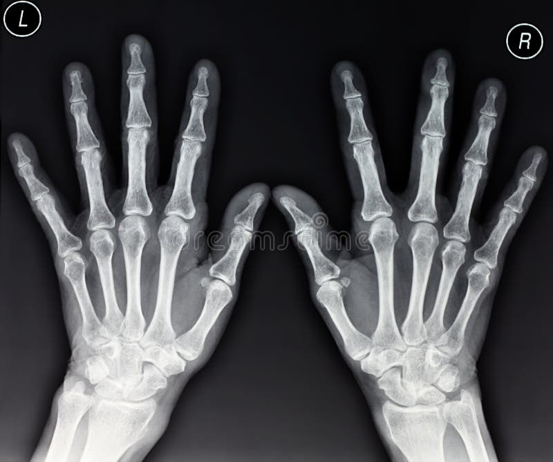 Rayon X Ou Radiographie De Main Photo stock - Image du phalange ...