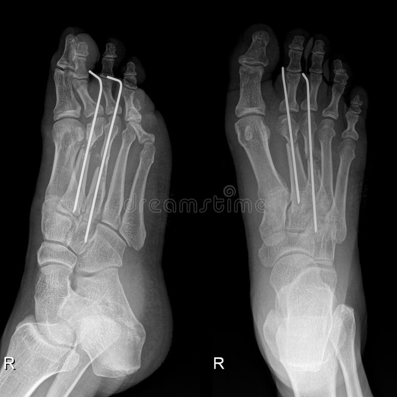 Rayon X de pied droit photo stock. Image du pied, squelette - 2783806