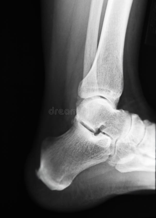 Osteotomy D'os De Talon Et Transfert De Tendon Photo stock - Image du ...
