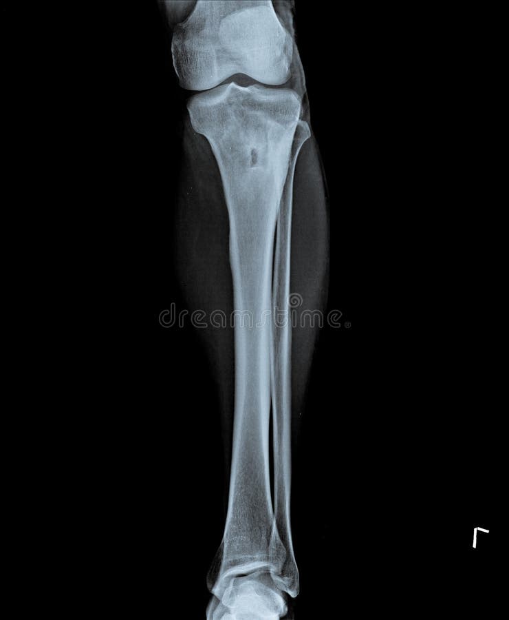 Blessure infectée image stock. Image du cicatrice, amputation - 65179897