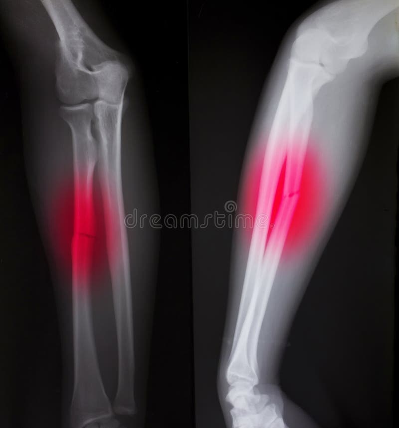 Rayon X Des Les Deux Genou Humain Photo stock - Image du tige, zone ...
