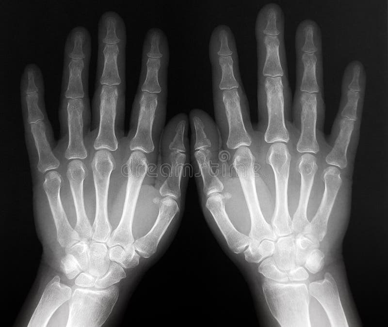 Rayon X Des Deux Mains - Radiographie Image stock - Image du anatomie ...