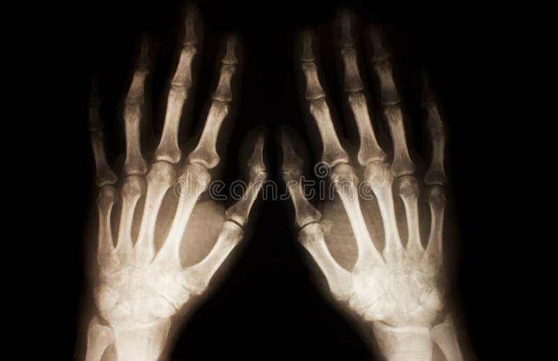 Rayon X des mains photo stock. Image du doigt, représentation - 14359816