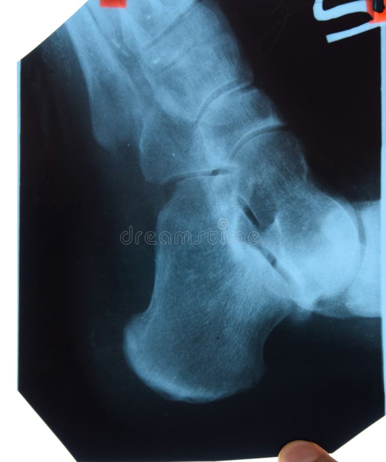 Rayon X Des Pieds Et Os Du Talon. Image De Rayon X Photo stock - Image ...