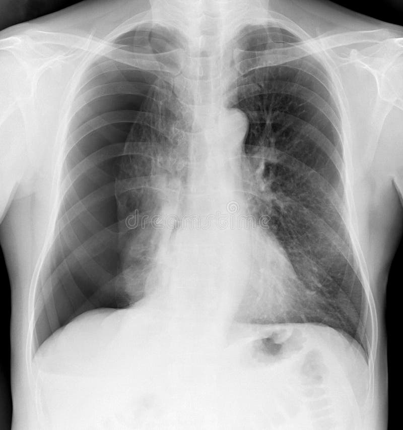 Radiographie Du Thorax D'un Homme Atteint D'un Pneumothorax Image stock ...