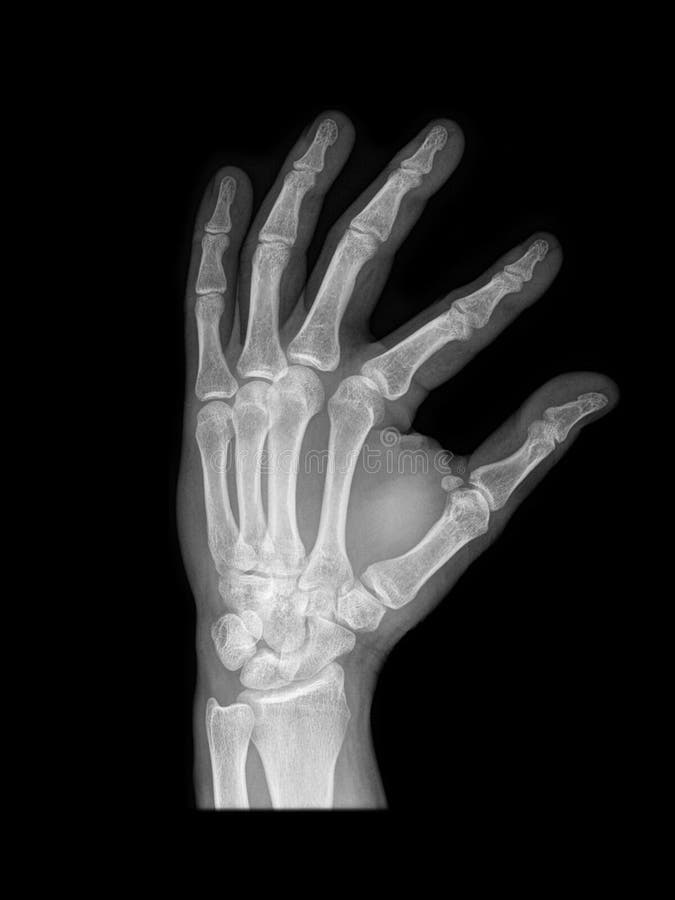 361 Photos de Radiographie De Main Et Poignet - Photos de stock ...