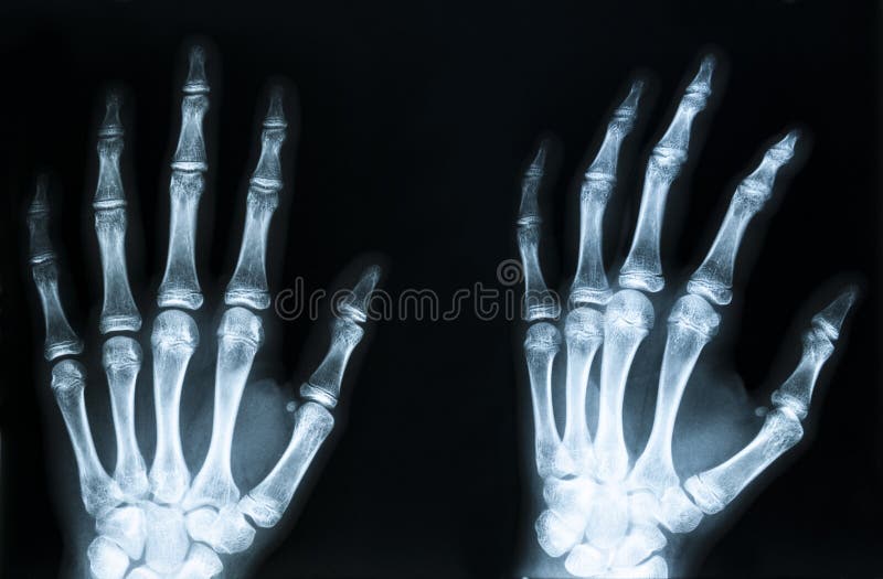 Rayon Distal De Fracture (l'os De L'avant-bras) Image stock - Image du ...