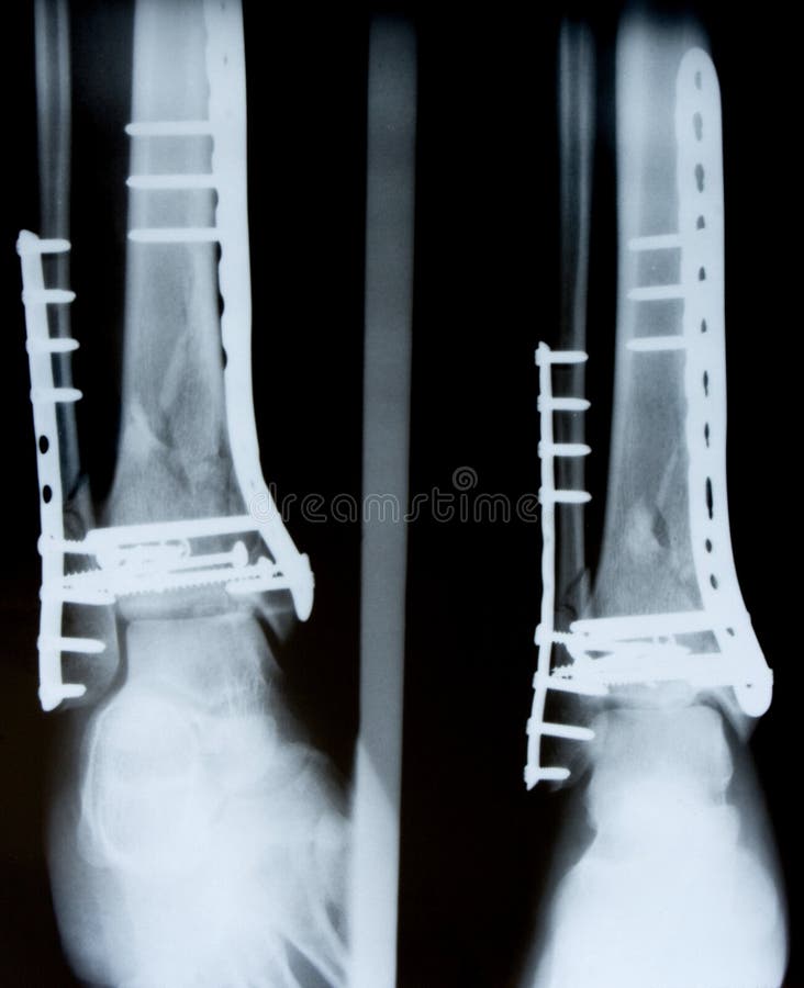 Fracture Au Cou De L'humérus (os De Bras) (épaule Laissée Par Rayon X ...