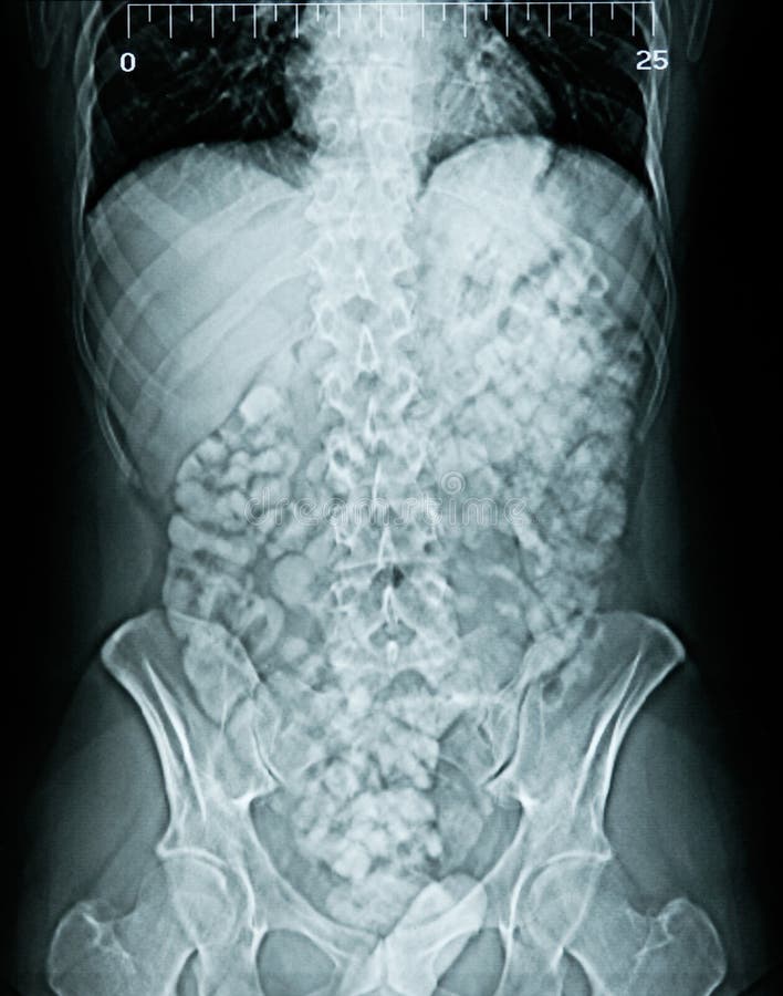 Radiographie du cou image stock. Image du gorge, rayon - 3054901