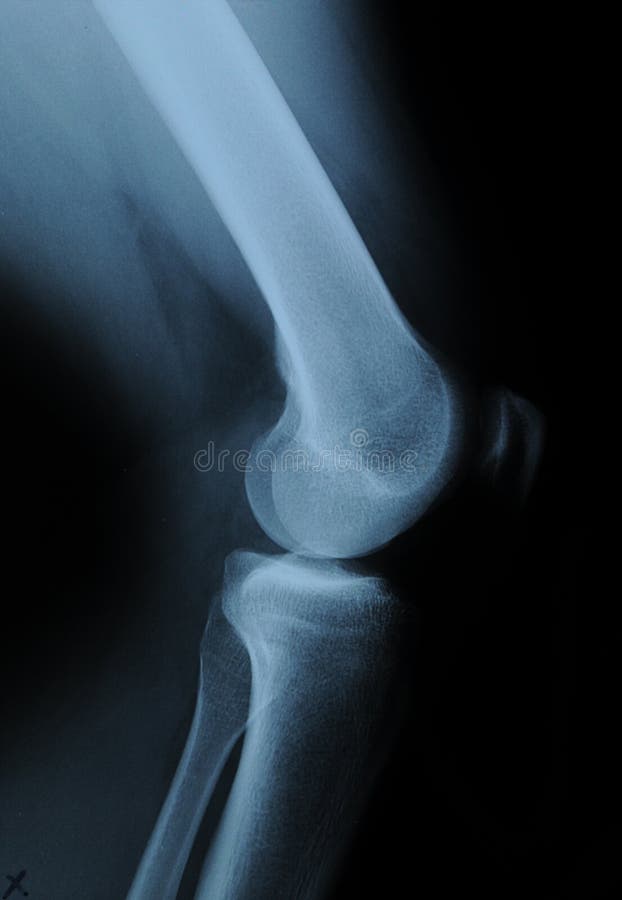 Rayon X image stock. Image du péroné, cubitus, analyse - 8009323