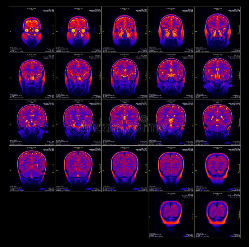 Real Brain MRI Slide of a Girl Stock Illustration - Illustration of ...
