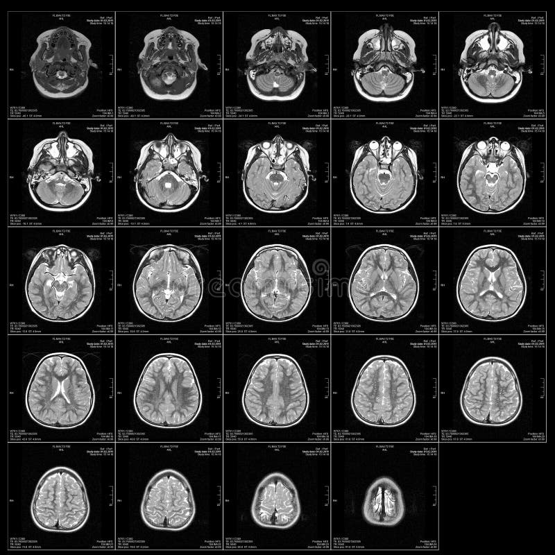 Real Brain MRI Slide of a Girl Stock Image - Image of brain, healthcare ...