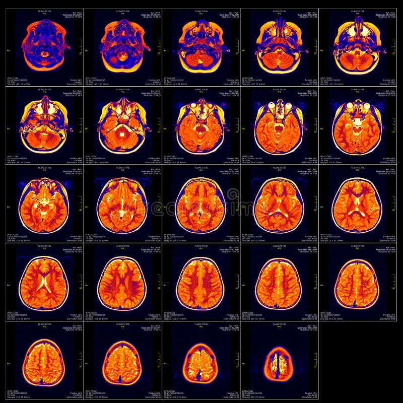 Real Brain stock image. Image of closeup, head, surgery - 146097