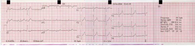 Typical Electrocardiogram Chart Accordion-folded. Stock Image - Image ...