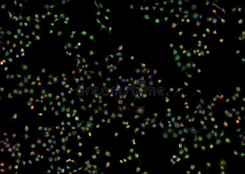 Real Fluorescence Microscopic View of Cancer Cells Stock Photo - Image ...