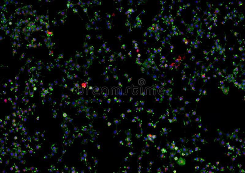 Real Fluorescence Microscopic View of Cancer Cells Stock Image - Image ...