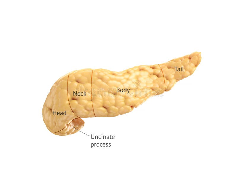 Pancreatitis Disease of Human Pancreas Isolated on White. 3d ...