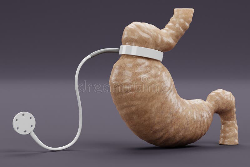 3D Render of Stomach with Gastric Band Stock Illustration ...