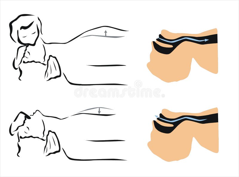 Reanimation stock vector. Illustration of exhale, assistance - 35931495