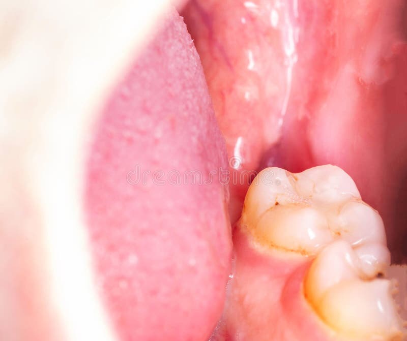 Recess after Complex Impacted Wisdom Tooth Extraction, Traumatic ...